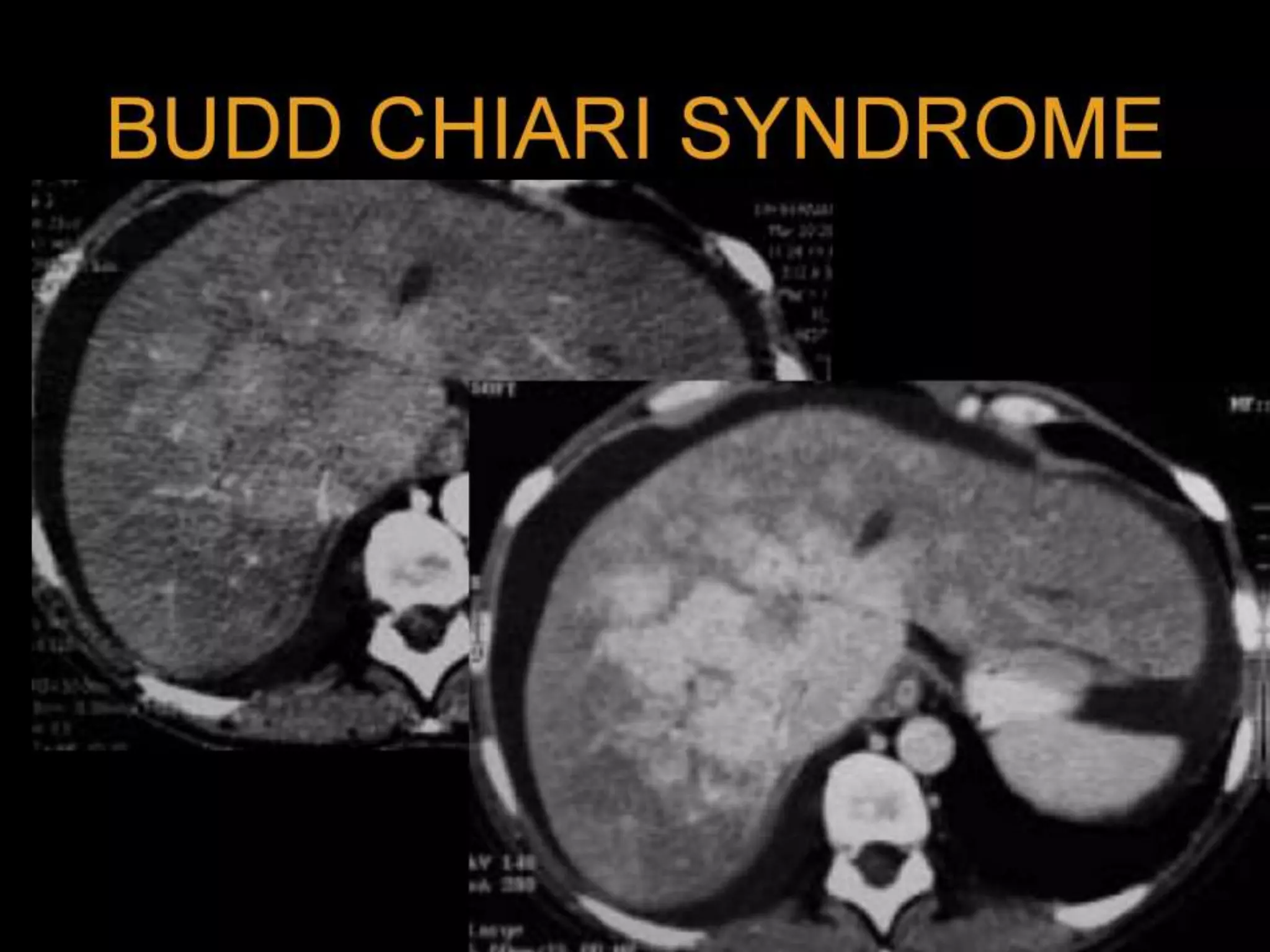 40-Dr Ahmed Esawy imaging oral board of liver part IV hepatic pseudolesions and pitfalls ...