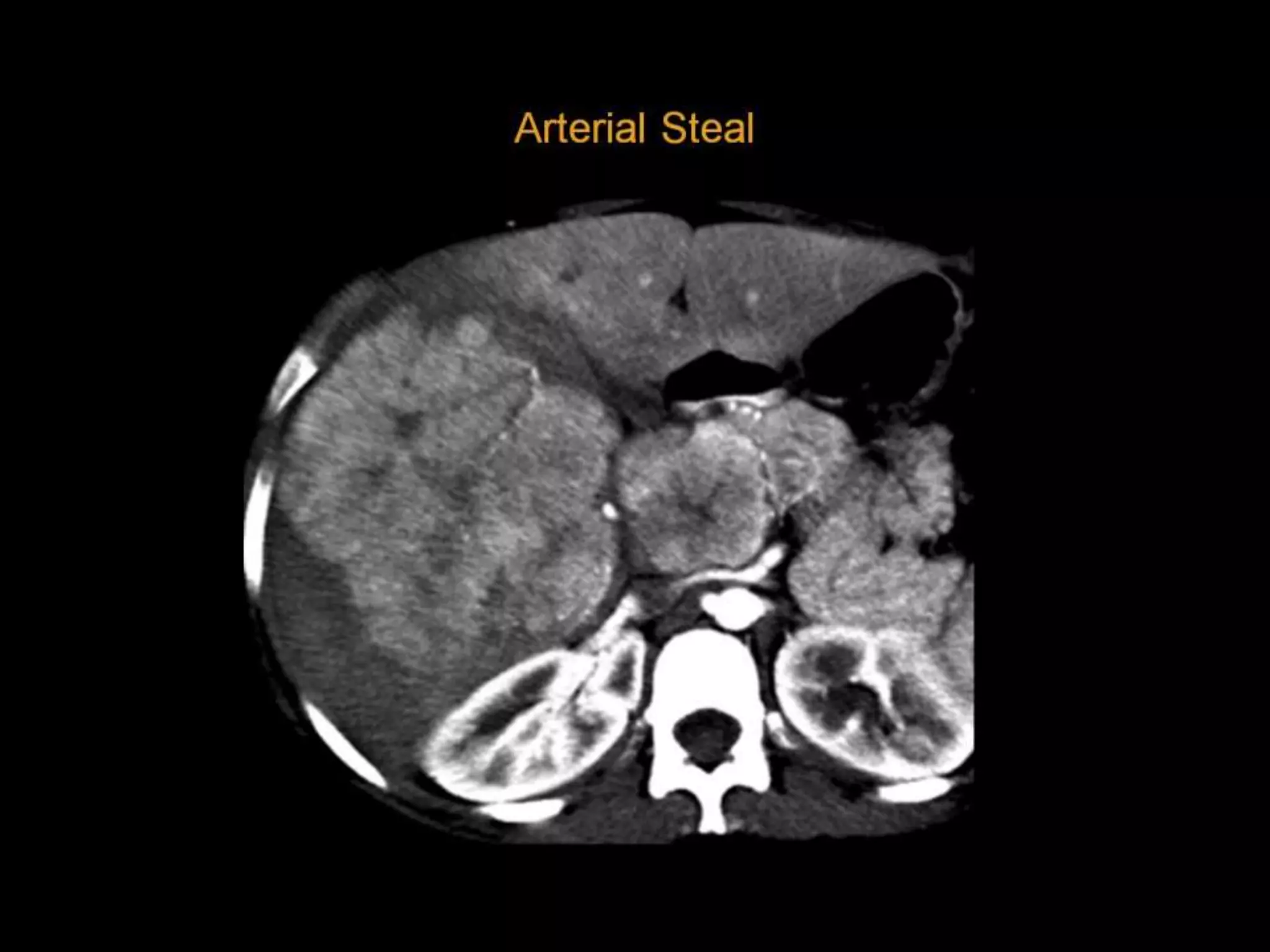 40-Dr Ahmed Esawy imaging oral board of liver part IV hepatic ...