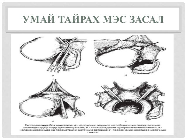 Төрсний дараах хожуу үеийн цус алдалт авах арга хэмжээ