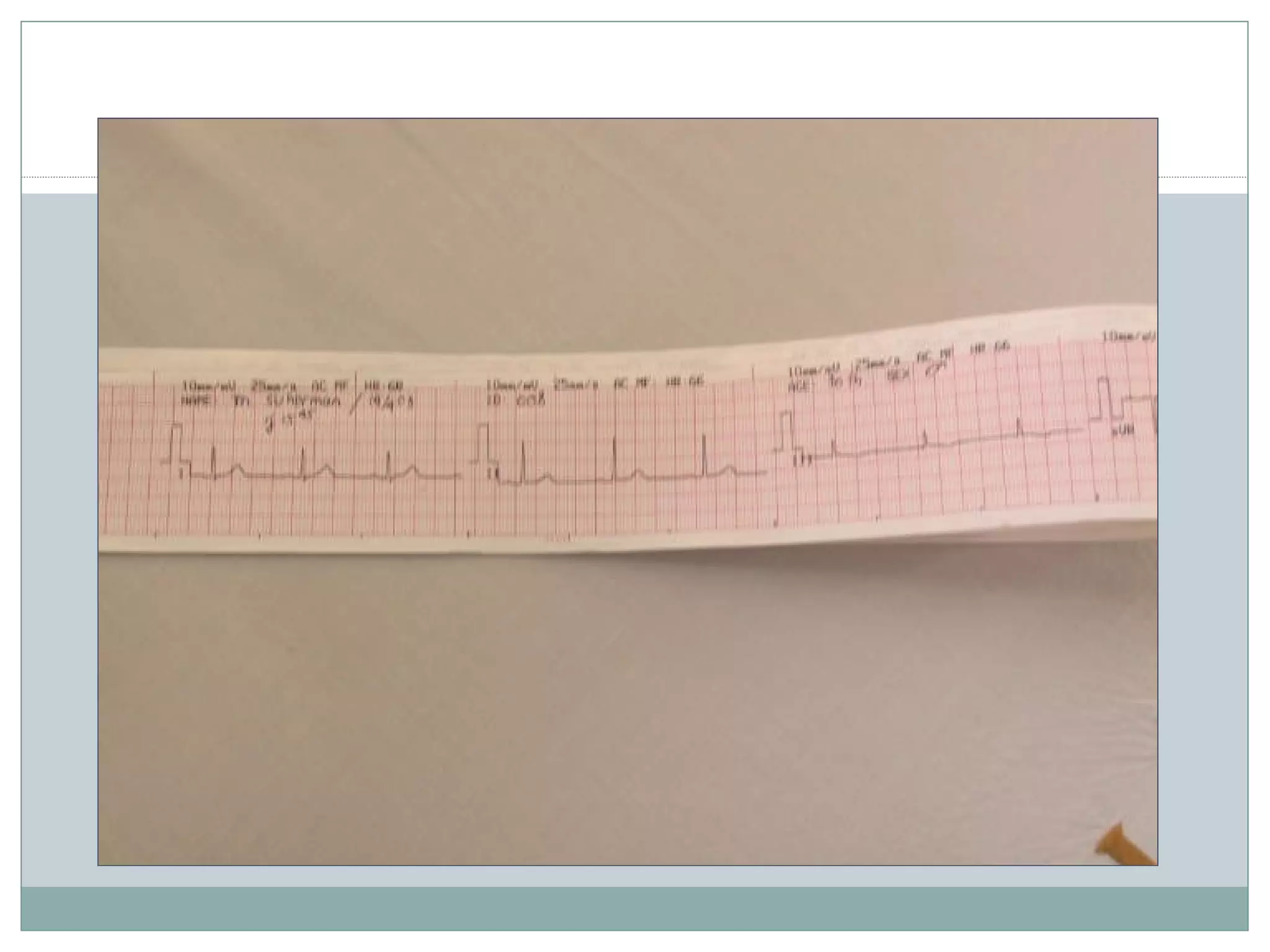 pengenalan-ekg-pati-ppt | PPT