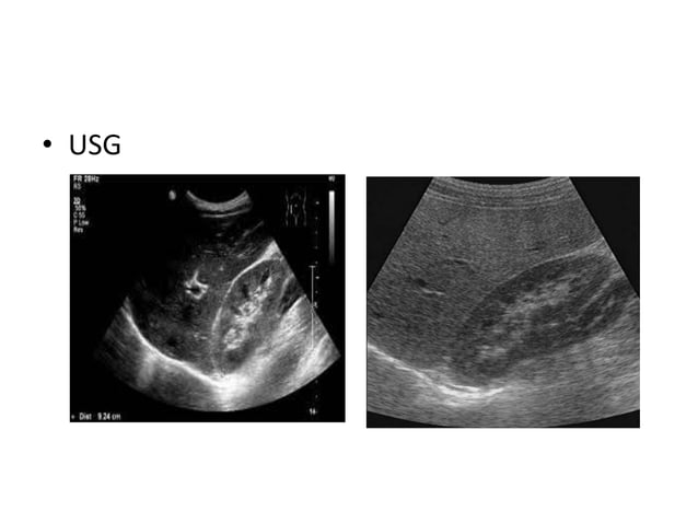 405821839 nefrolithiasis-pptx | PPTX