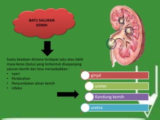 405821839 nefrolithiasis-pptx | PPTX
