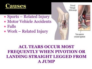 405 acl presentation | PPT