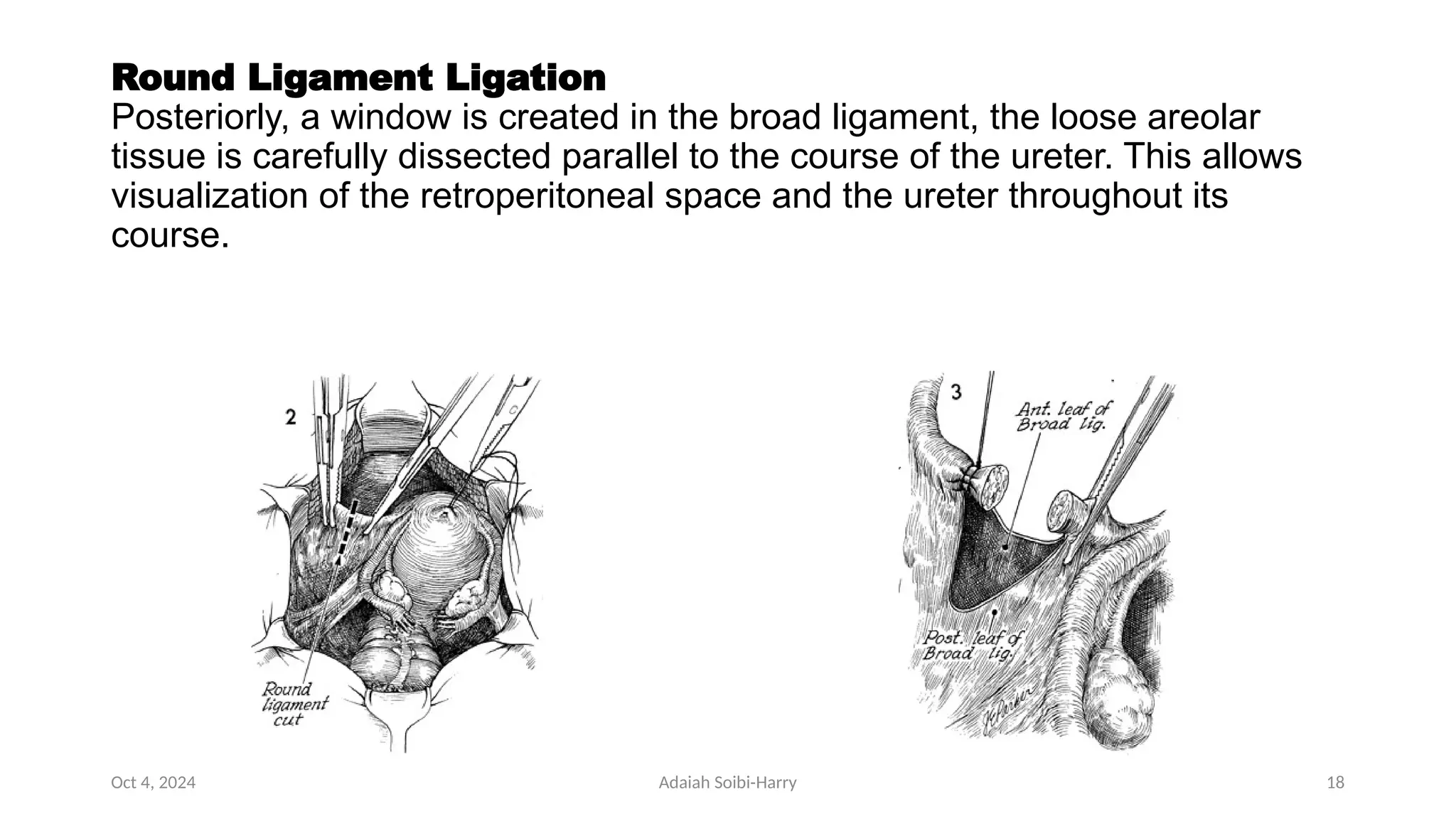 407102189-Obstetric-Hysterectomy-pptx-Modified.pptx