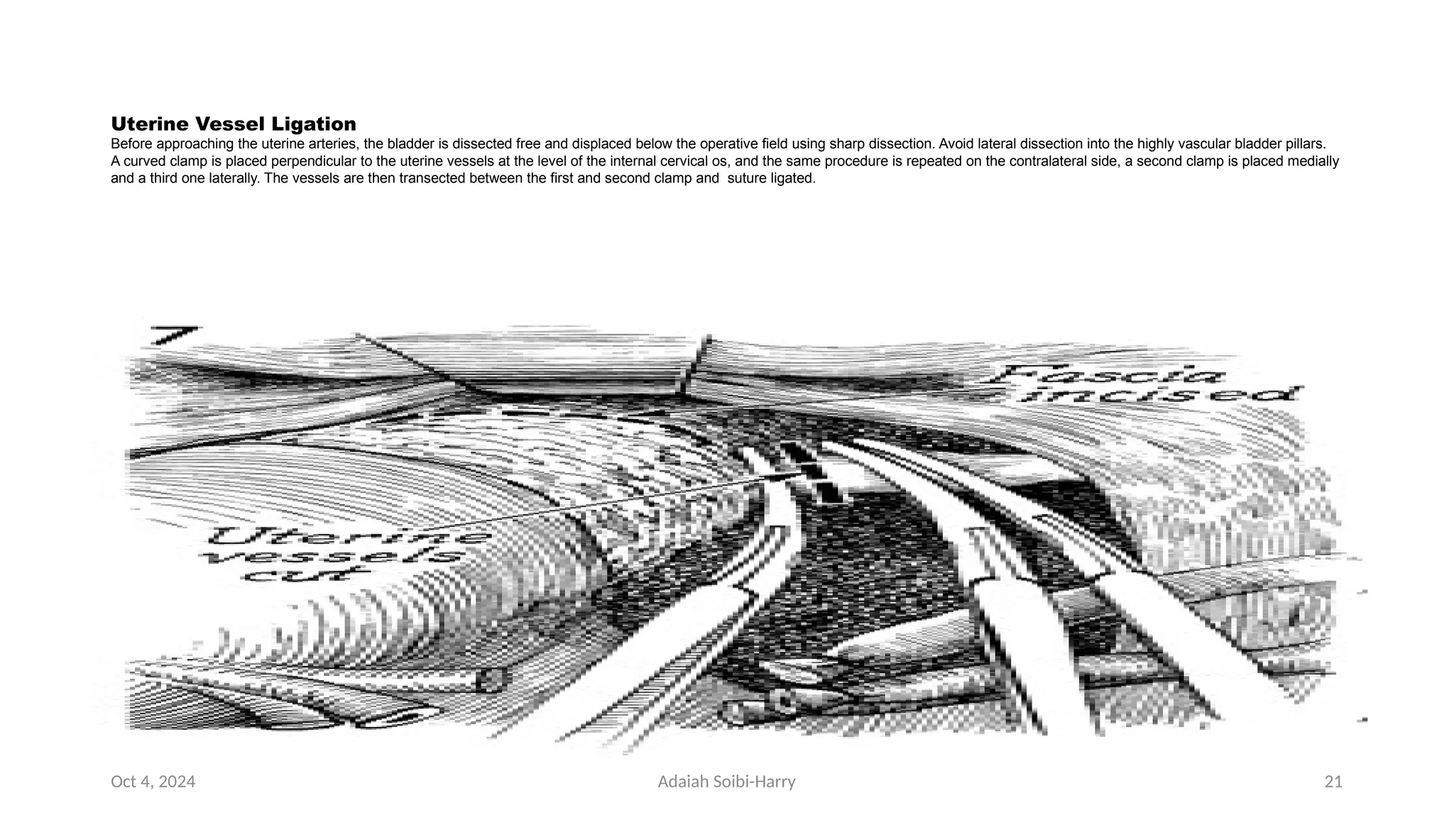 407102189-Obstetric-Hysterectomy-pptx-Modified.pptx