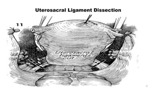 407102189-Obstetric-Hysterectomy-pptx-Modified.pptx