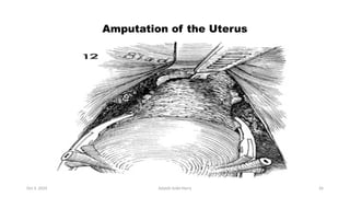407102189-Obstetric-Hysterectomy-pptx-Modified.pptx