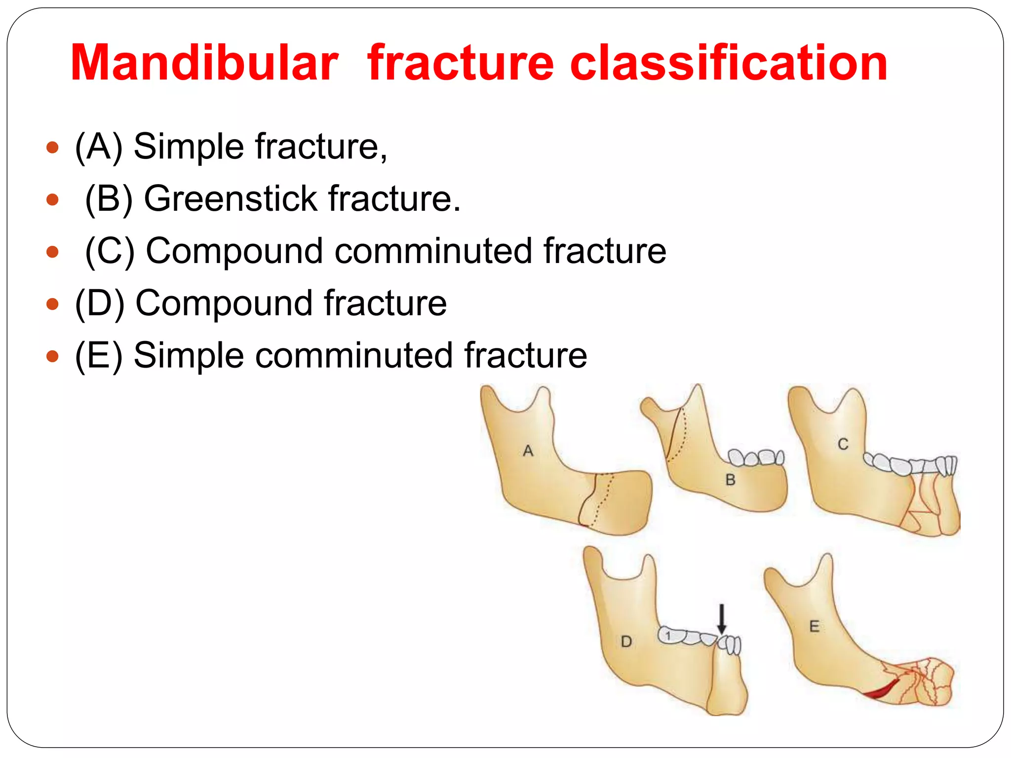 Mandibular-Fracture-1.pptx
