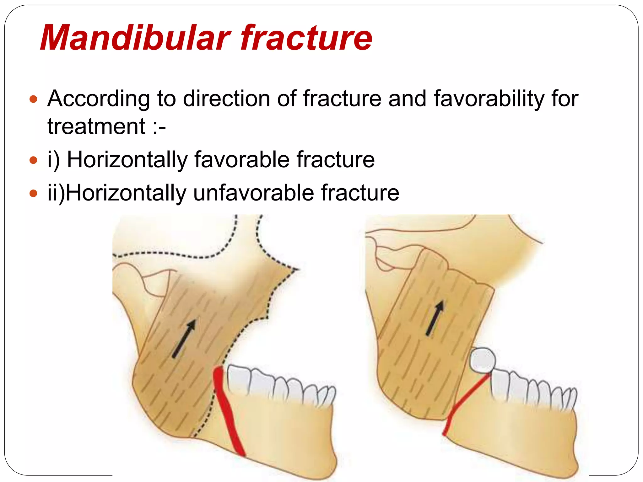 Mandibular-Fracture-1.pptx