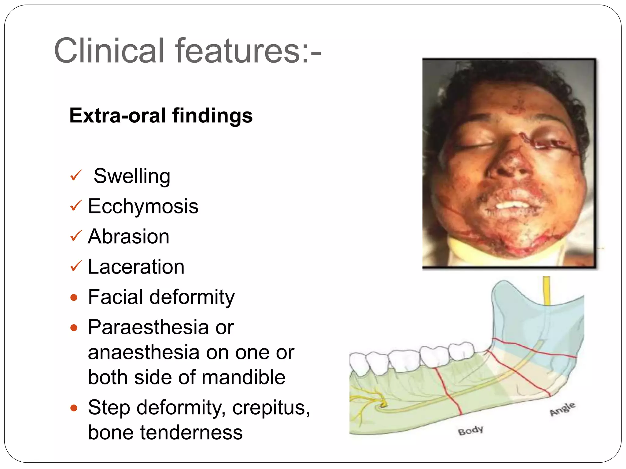 Mandibular-Fracture-1.pptx