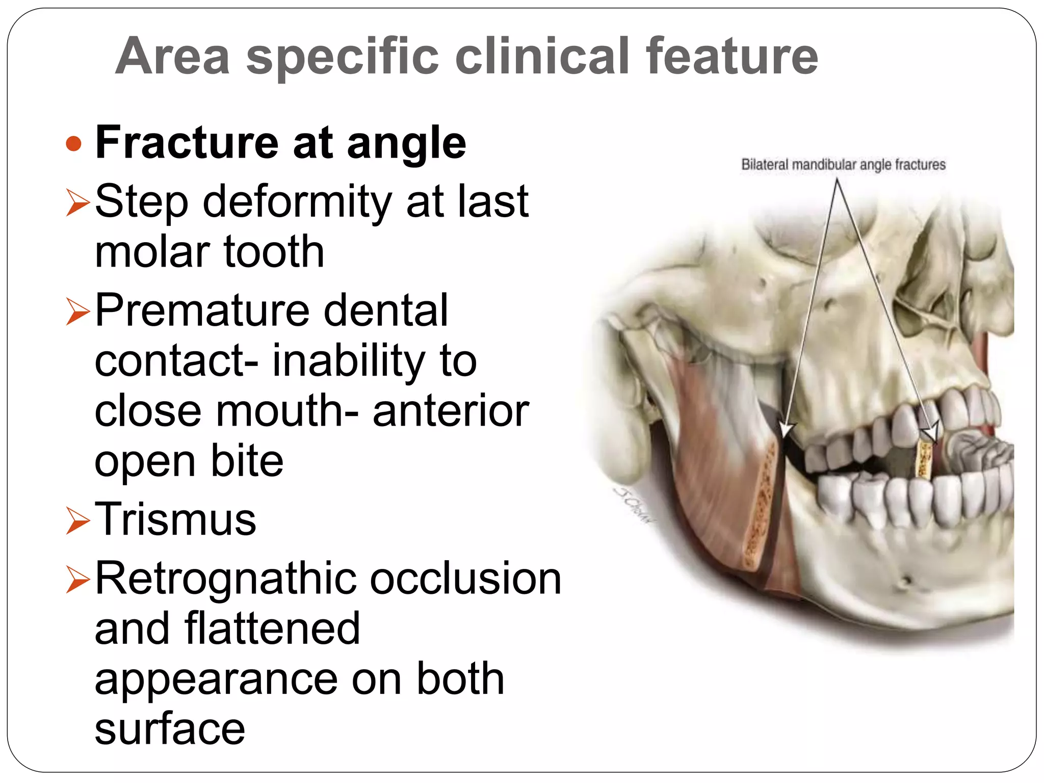 Mandibular-Fracture-1.pptx