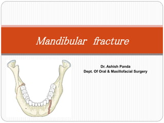 Mandibular-Fracture-1.pptx