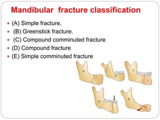 Mandibular-Fracture-1.pptx