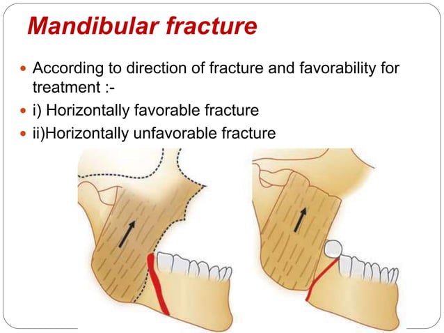 Mandibular-Fracture-1.pptx