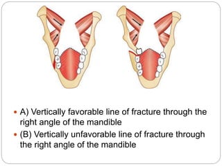 Mandibular-Fracture-1.pptx