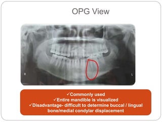 Mandibular-Fracture-1.pptx