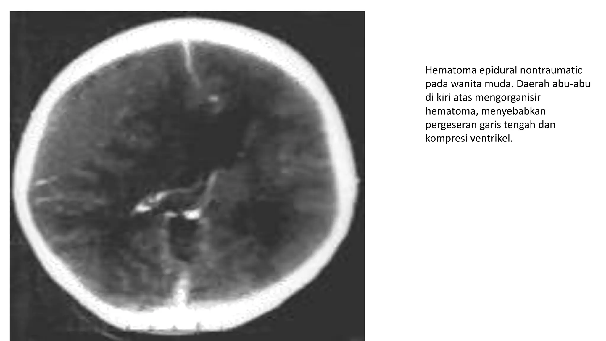 409561075-SDH-EDH-ICH-IVH-SAH.pptx