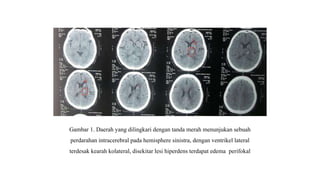 409561075-SDH-EDH-ICH-IVH-SAH.pptx