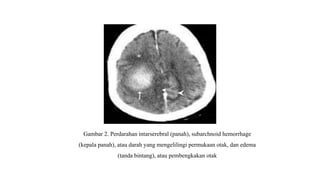 409561075-SDH-EDH-ICH-IVH-SAH.pptx