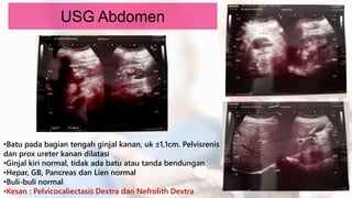 409651743 nefrolithiasis | PPT