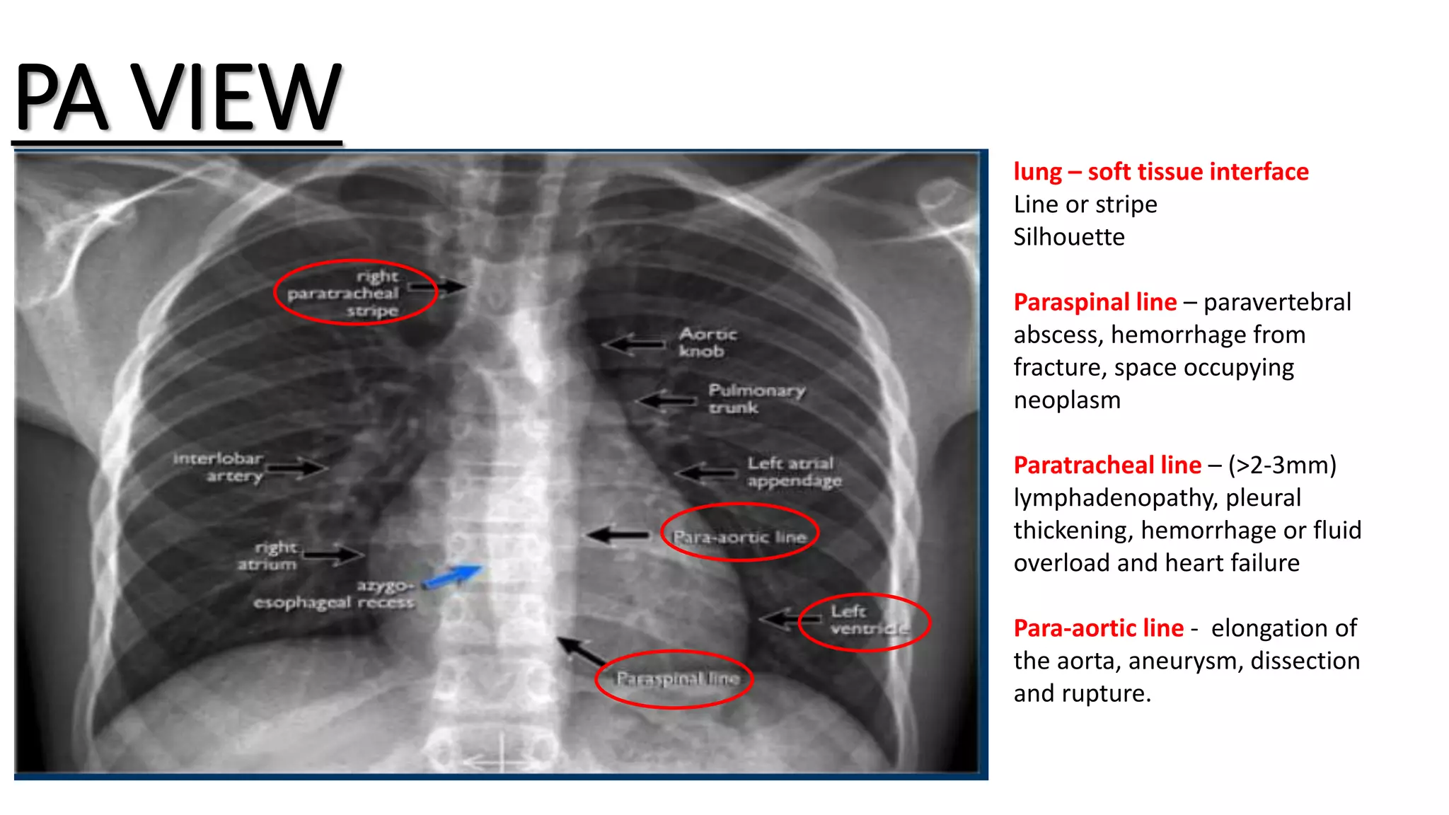 409855422-CHEST-X-RAY.pptx | Heart and Cardiovascular Diseases ...
