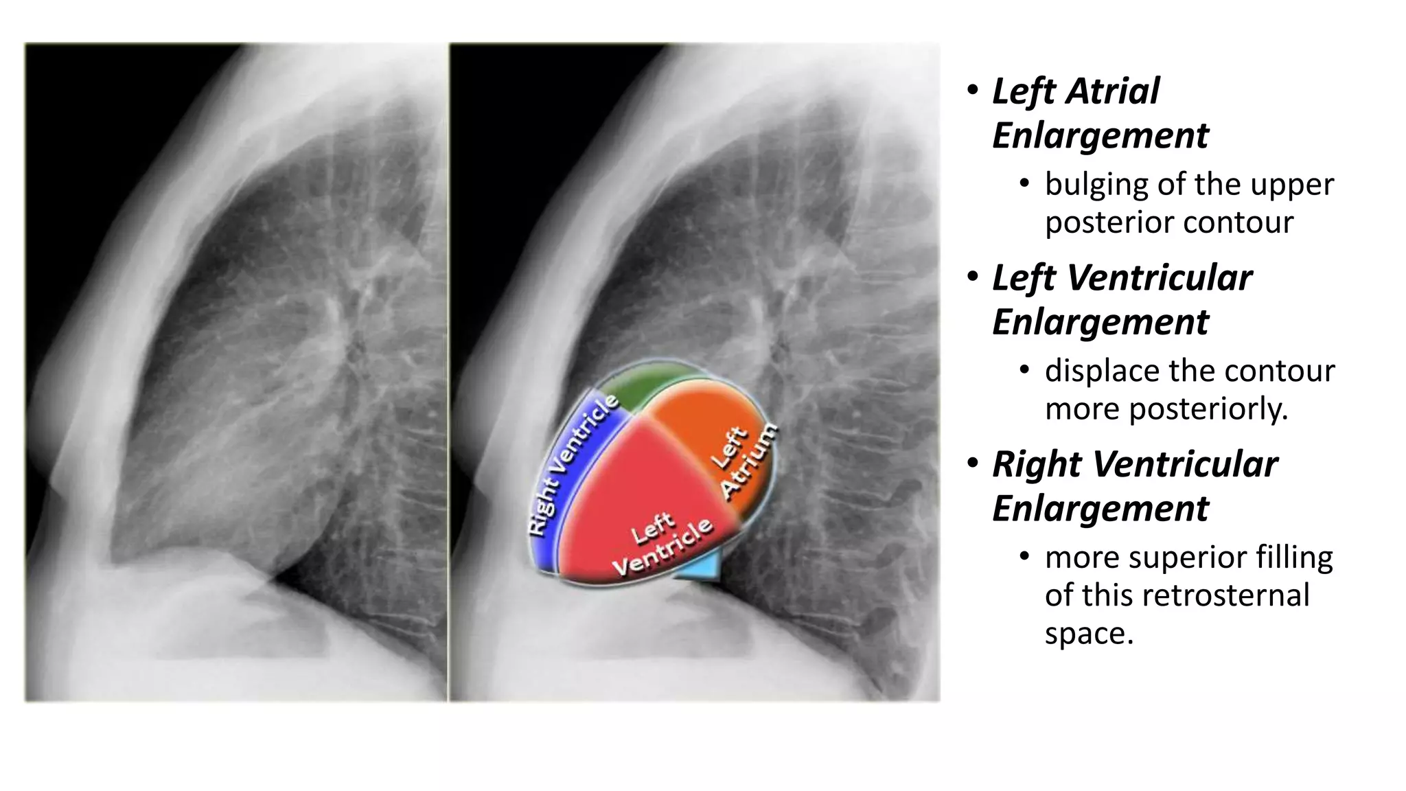 409855422-CHEST-X-RAY.pptx | Heart and Cardiovascular Diseases ...