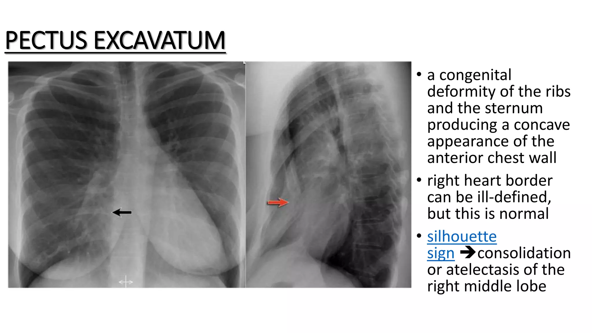 409855422-CHEST-X-RAY.pptx | Heart and Cardiovascular Diseases ...