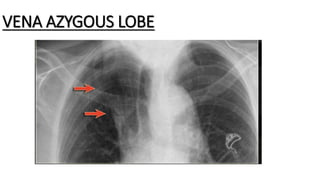 409855422-CHEST-X-RAY.pptx