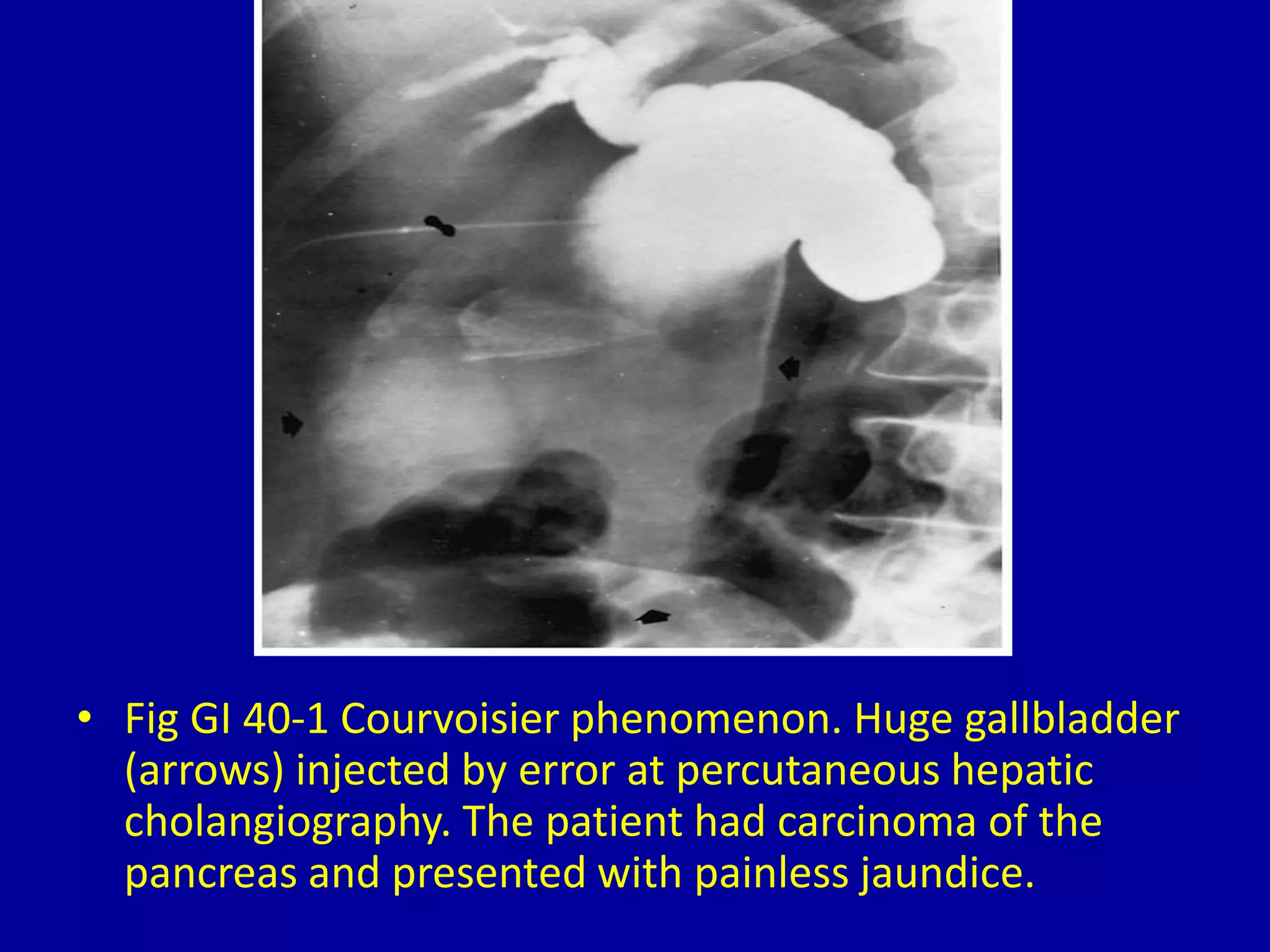 40 alterations in gallbladder size | PPTX | Digestive Disorders ...
