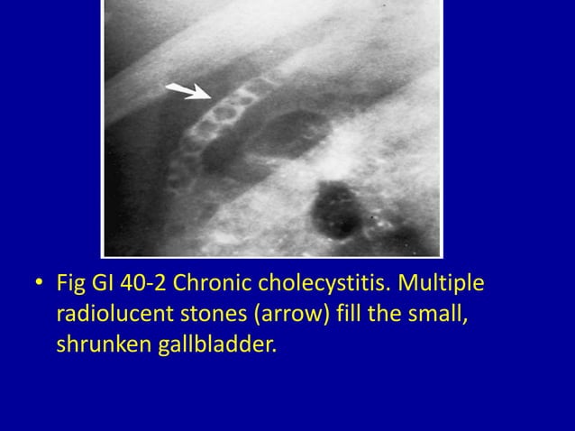 40 alterations in gallbladder size | PPTX | Digestive Disorders ...