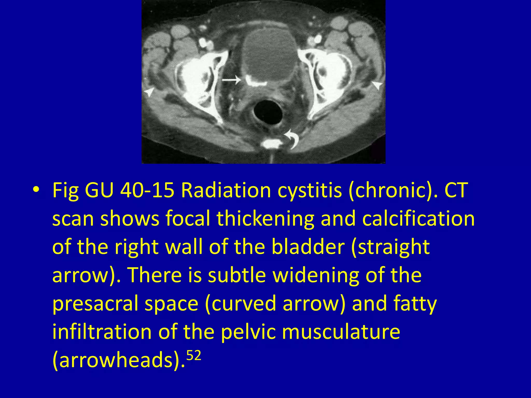 40 bladder masses on computed tomography and magnetic | PPT