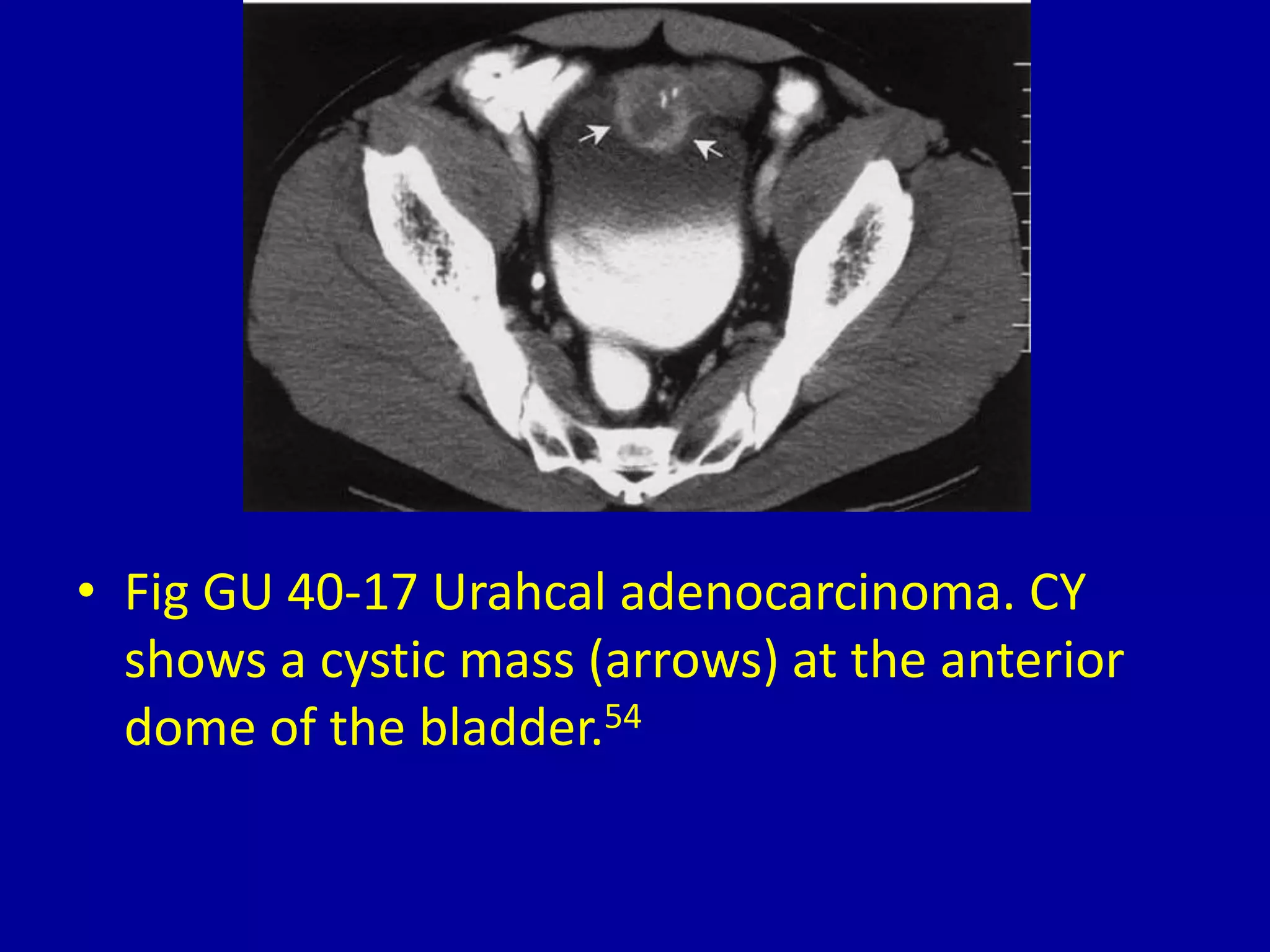 40 bladder masses on computed tomography and magnetic | PPT