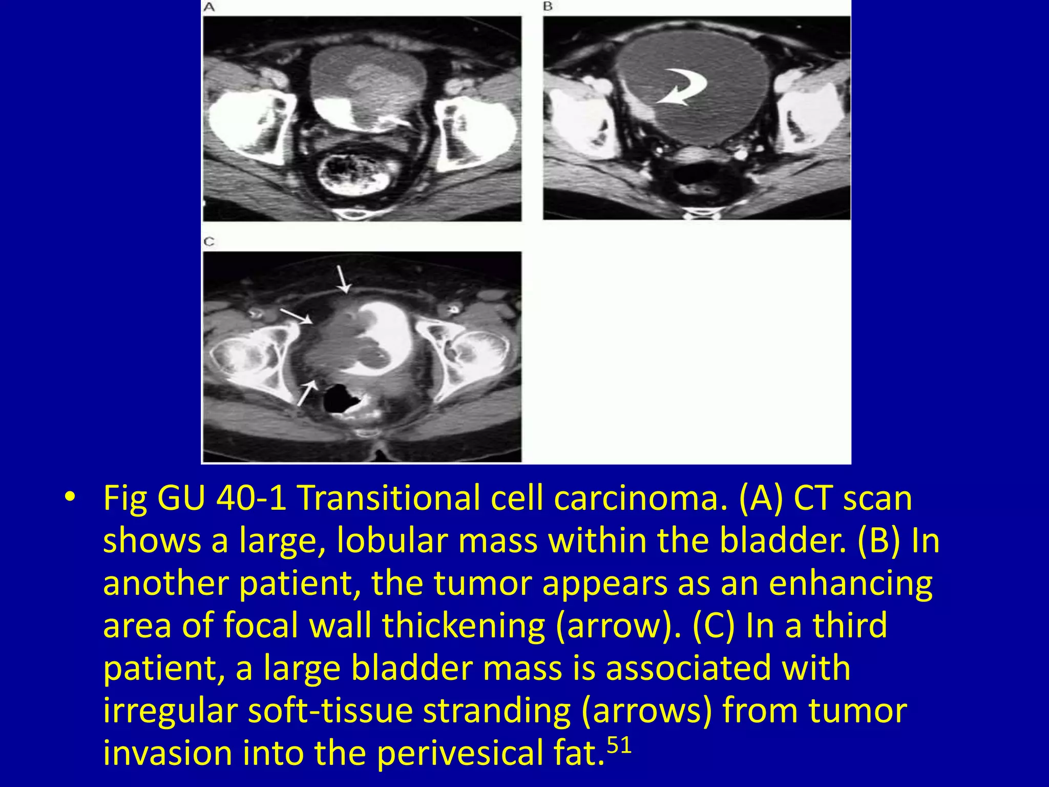 40 bladder masses on computed tomography and magnetic | PPT