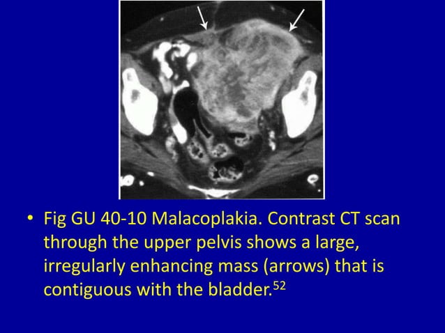 40 bladder masses on computed tomography and magnetic | PPT