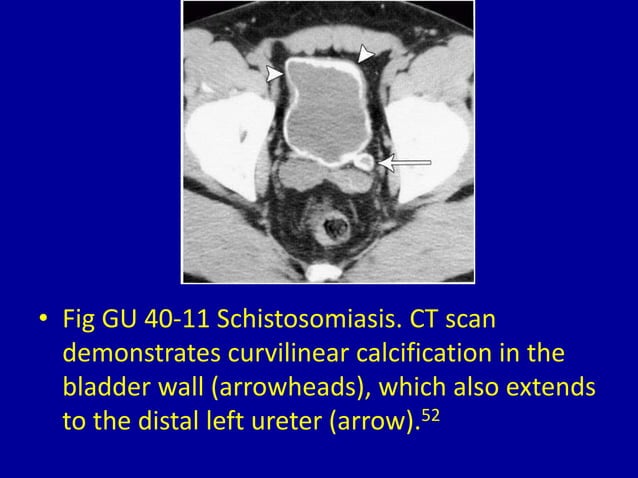 40 bladder masses on computed tomography and magnetic | PPT