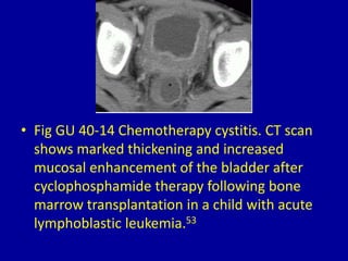 40 bladder masses on computed tomography and magnetic | PPT