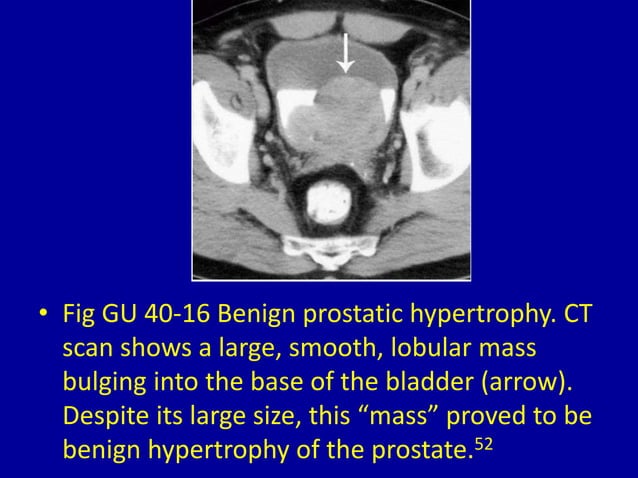 40 bladder masses on computed tomography and magnetic | PPT
