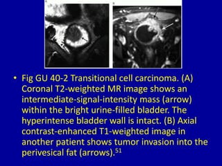 40 bladder masses on computed tomography and magnetic | PPT