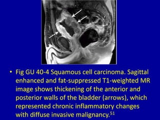 40 bladder masses on computed tomography and magnetic | PPT