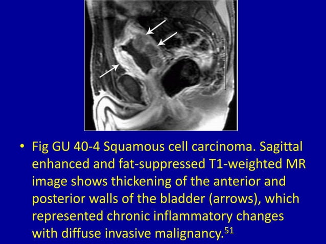 40 bladder masses on computed tomography and magnetic | PPT