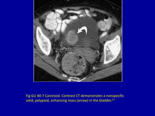 40 bladder masses on computed tomography and magnetic | PPT