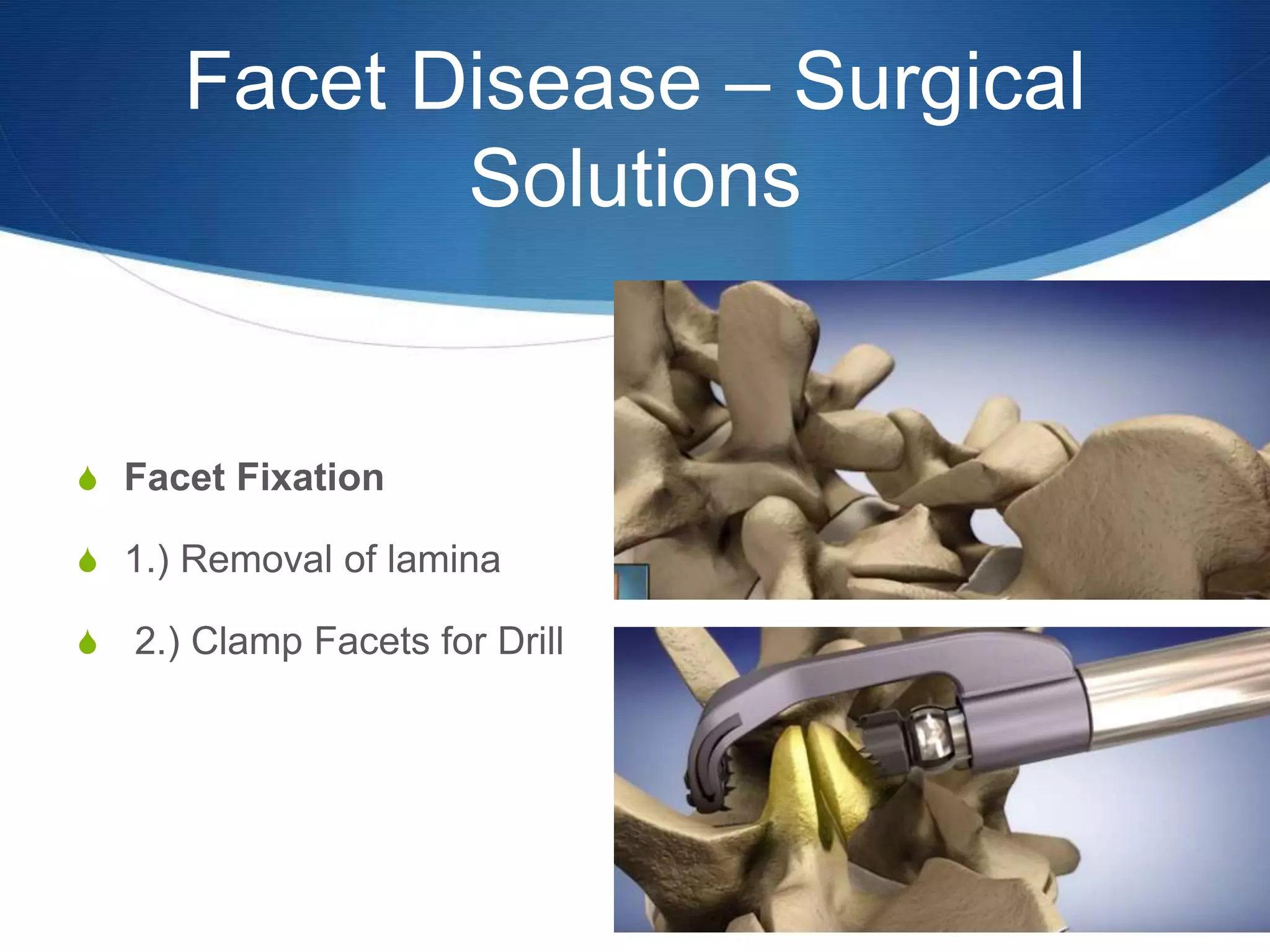 Facet disease | PPT