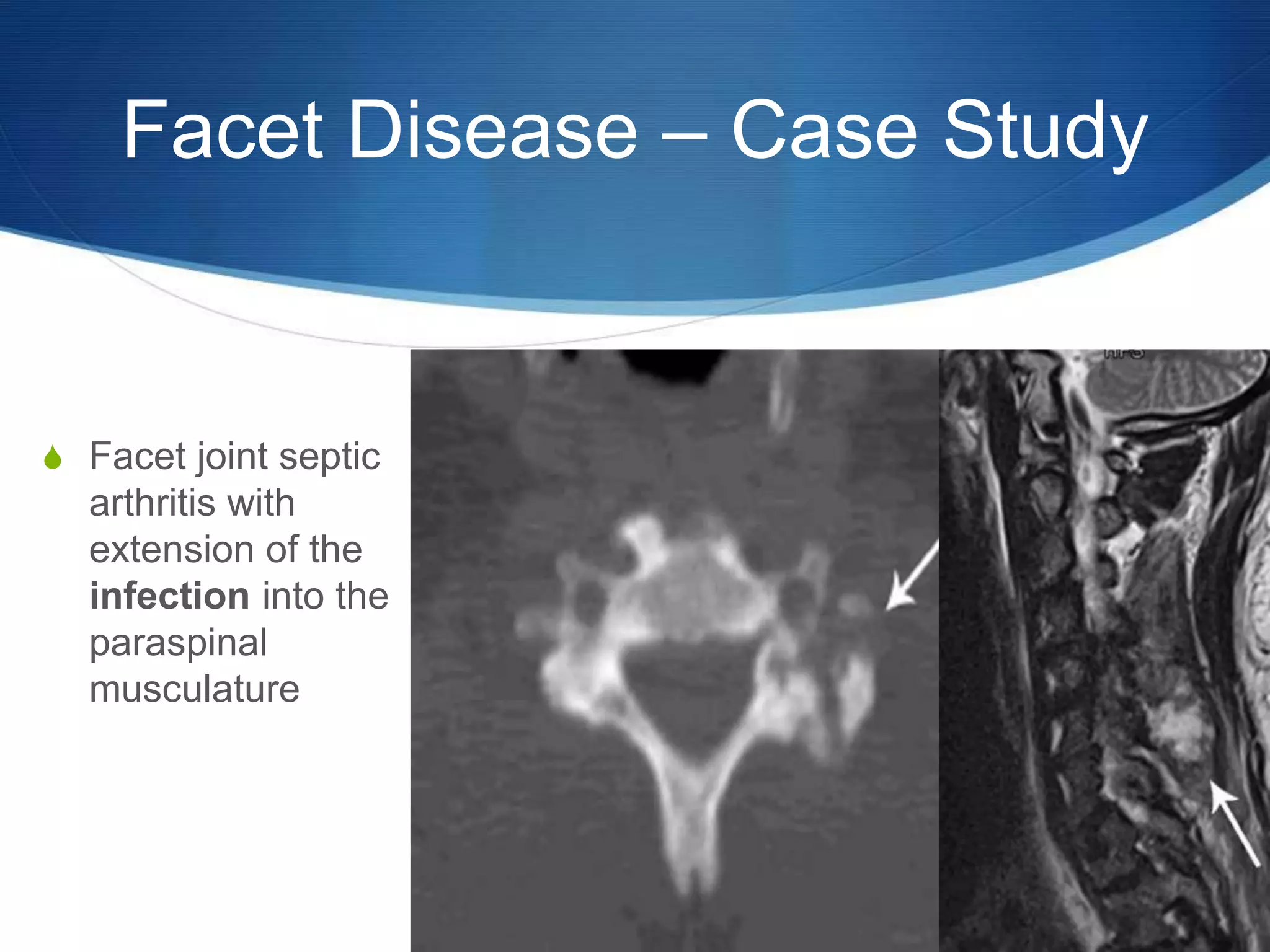 Facet disease | PPT