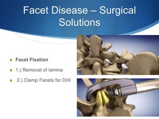 Facet disease | PPTX