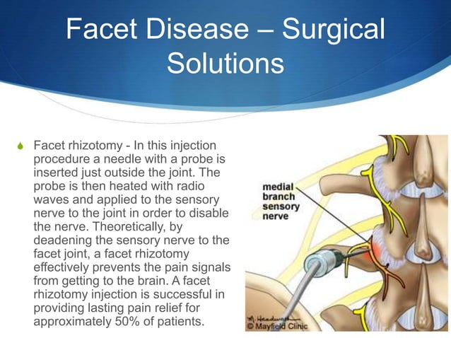 Facet disease | PPT