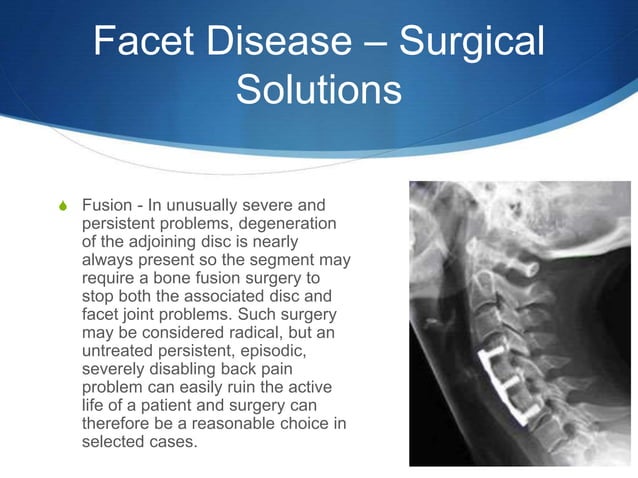 Facet disease | PPT