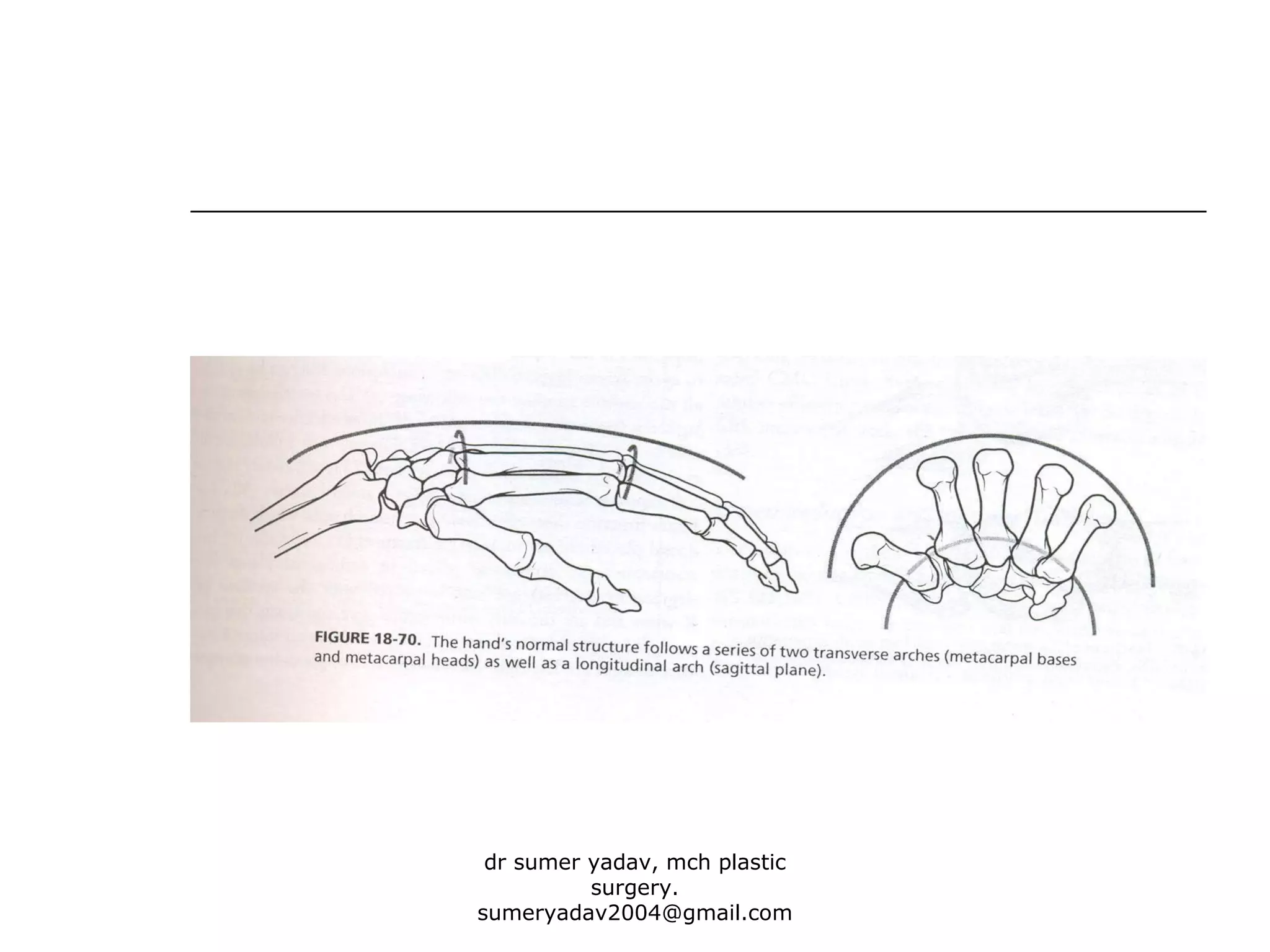 fractures of hand bones | PPT