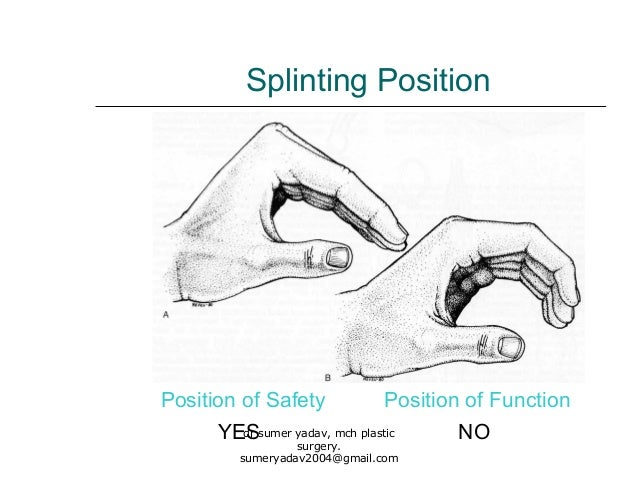 fractures of hand bones