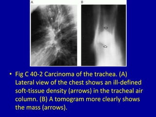 40 tracheal mass | PPT