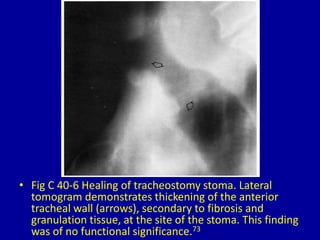 40 tracheal mass | PPT